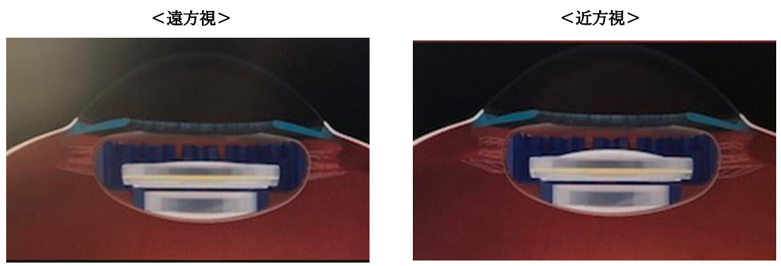 Accomodating IOL – Mirai Eye Inc.