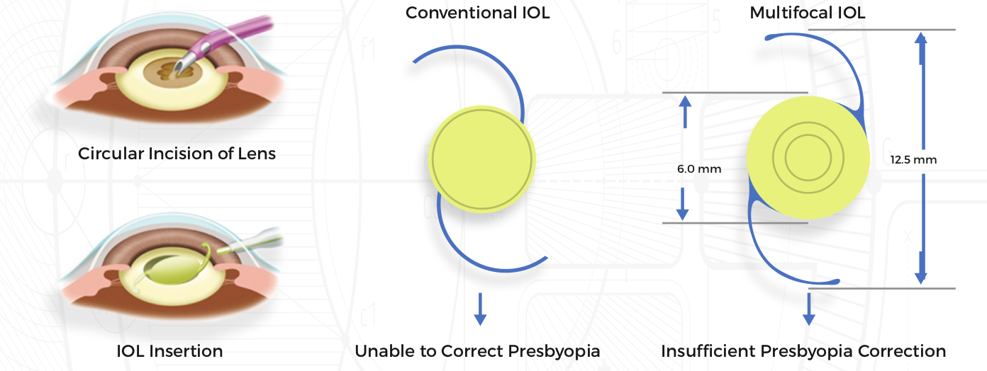Accomodating IOL – Mirai Eye Inc.