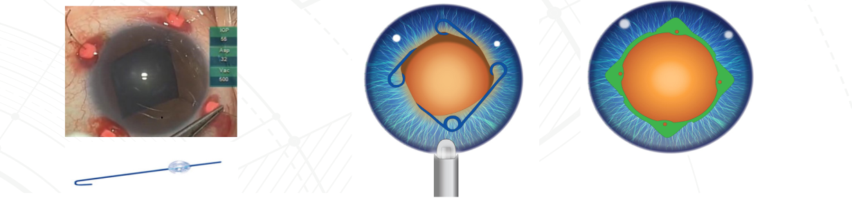 Surgical Instruments – Mirai Eye Inc.