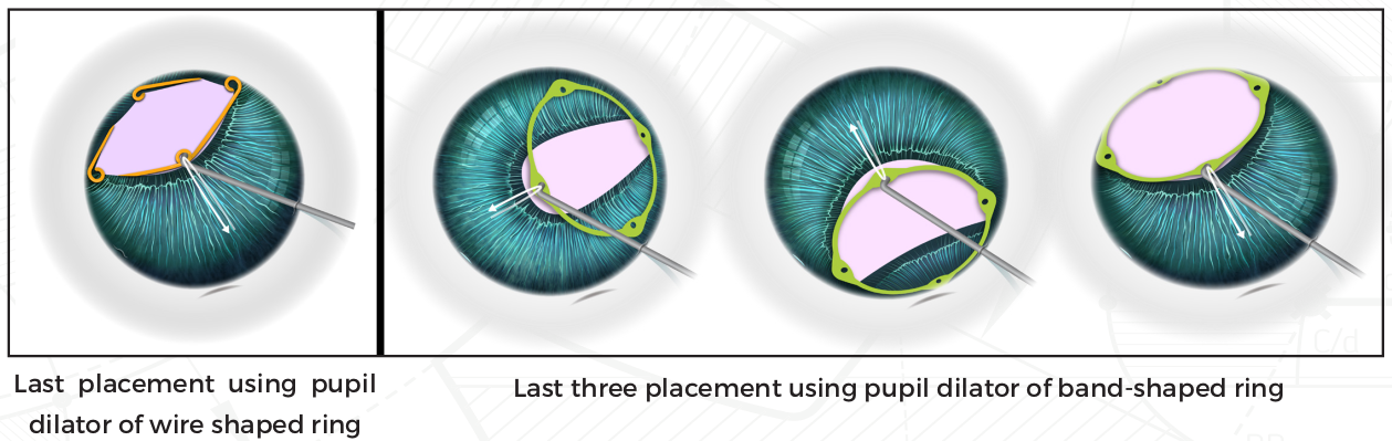 Surgical Instruments – Mirai Eye Inc.
