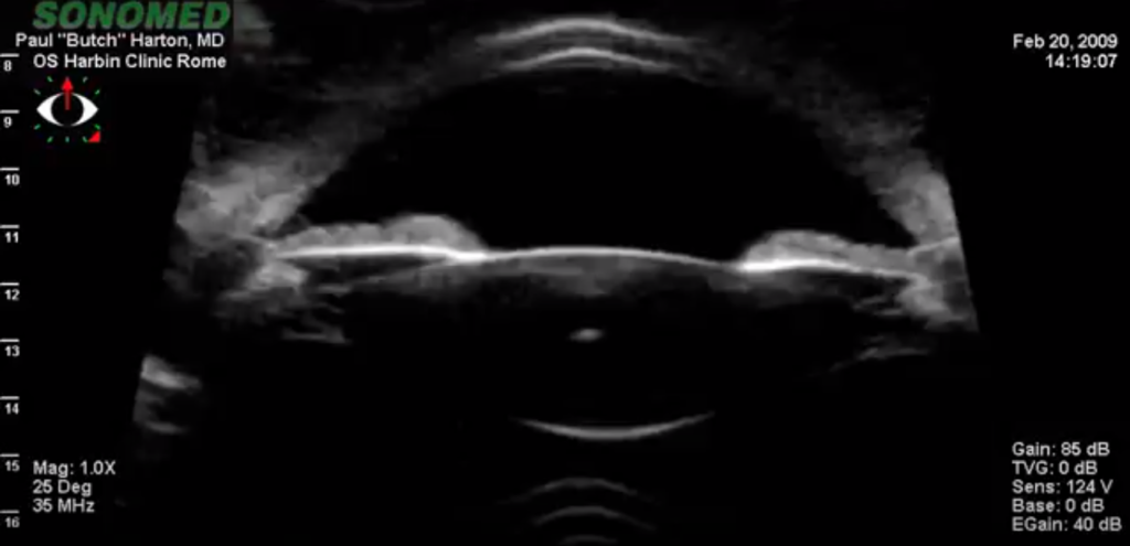 Accomodating IOL – Mirai Eye Inc.